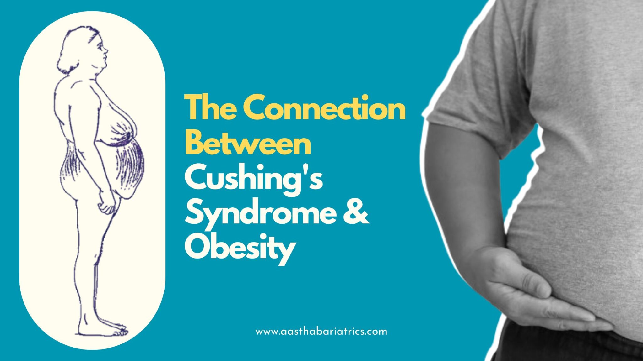 The Connection Between Cushing's Syndrome and Obesity